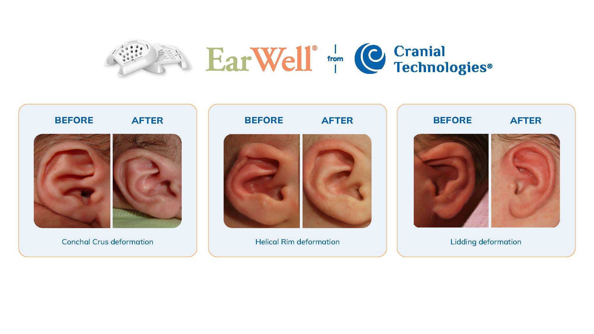 EarWell - TopD2C | Cranial Technologies
