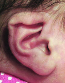 What To Know About Infant Ear Shape Deformities | Cranial Technologies